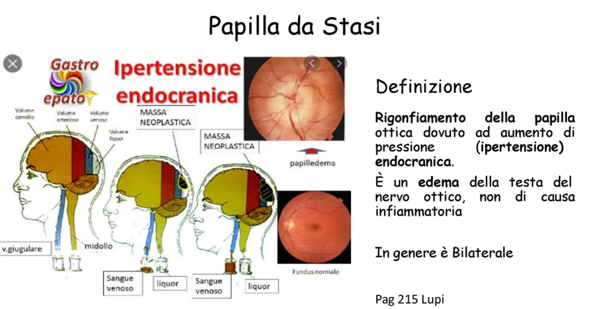 Papilla da Stasi, Gastro Epato | Algor Library